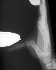 Thumb Sprains-Gamekeeper Thumb-Skier Thumb-Hand Surgery-Wrist Surgery ...