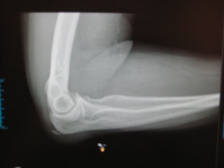 Olecranon Bursitis-Hand Surgery-Wrist Surgery-Elbow Surgery