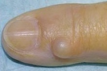 Arthritis Osteoarthritis of the Hand-Hand Surgery-Wrist Surgery-Elbow ...